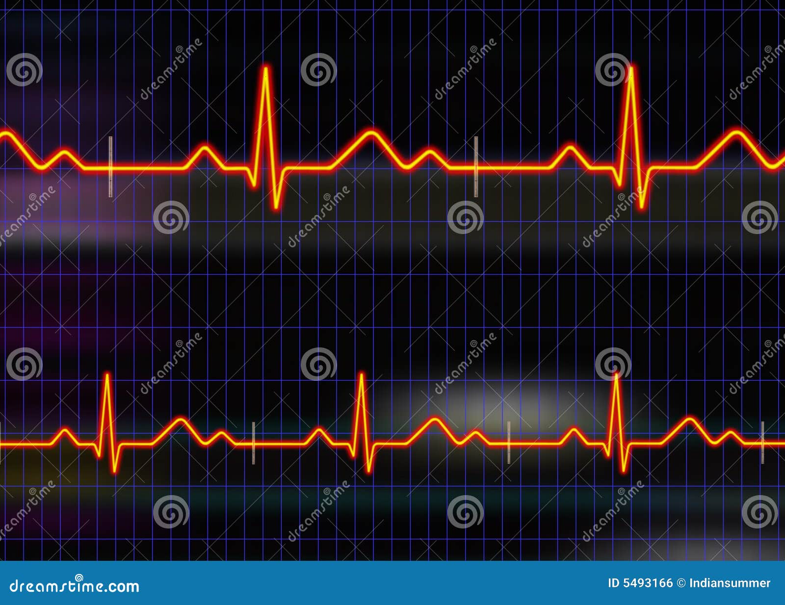 Cardiogram, Hope For Survival, Resuscitation Of Human Life, Pulse. Ekg ...