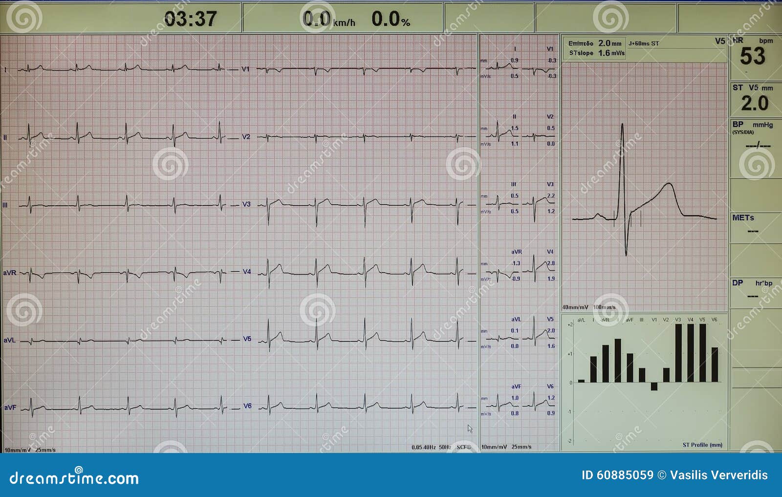 Cardiogram Image on Computer Screen at the Hospital Stock Image - Image ...