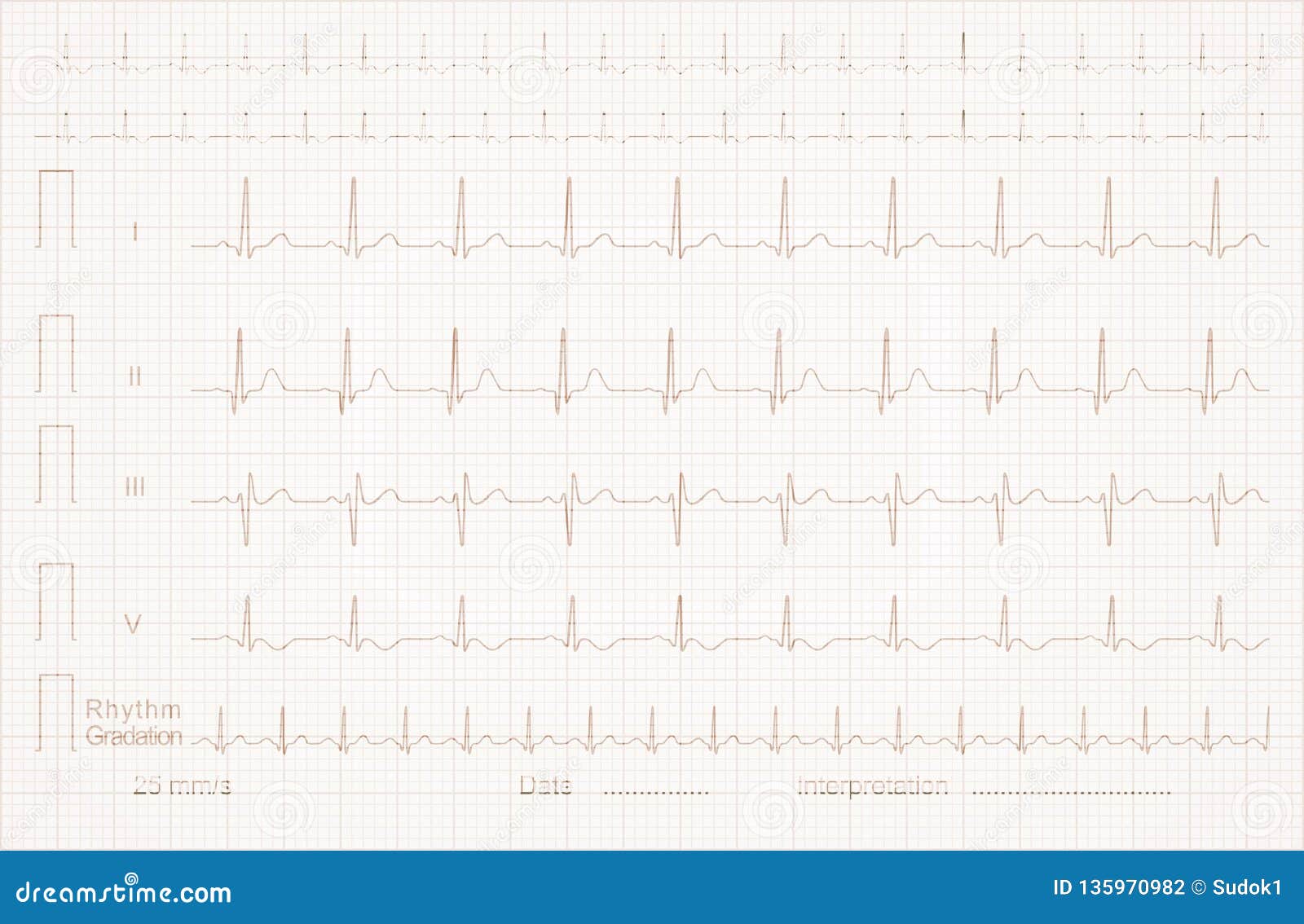Cardiogramma Sulla Carta Millimetrata Lineare Illustrazione di Stock ...