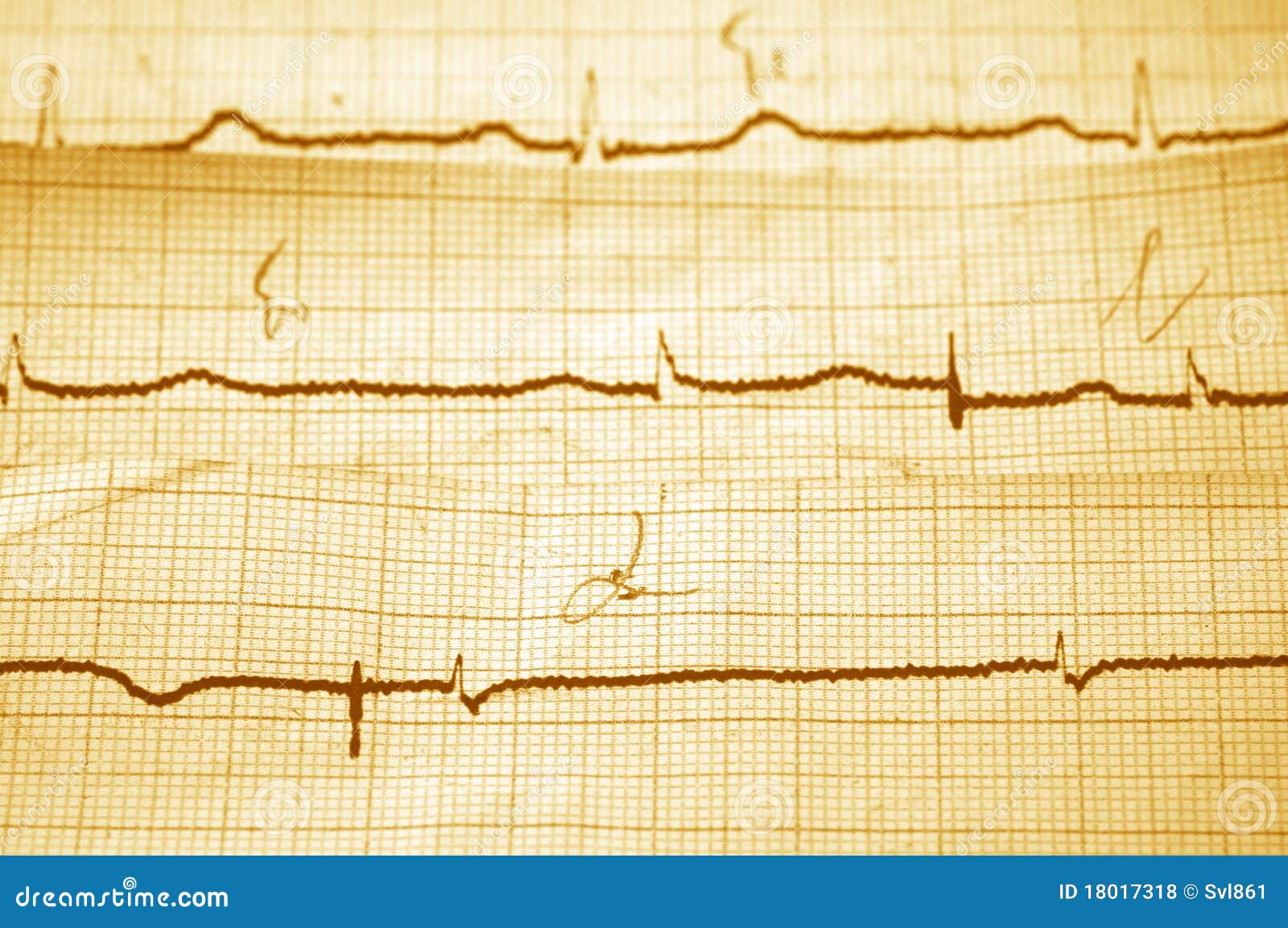 Cardiogramme photo stock. Image du analysez, électrocardiogramme - 18017318