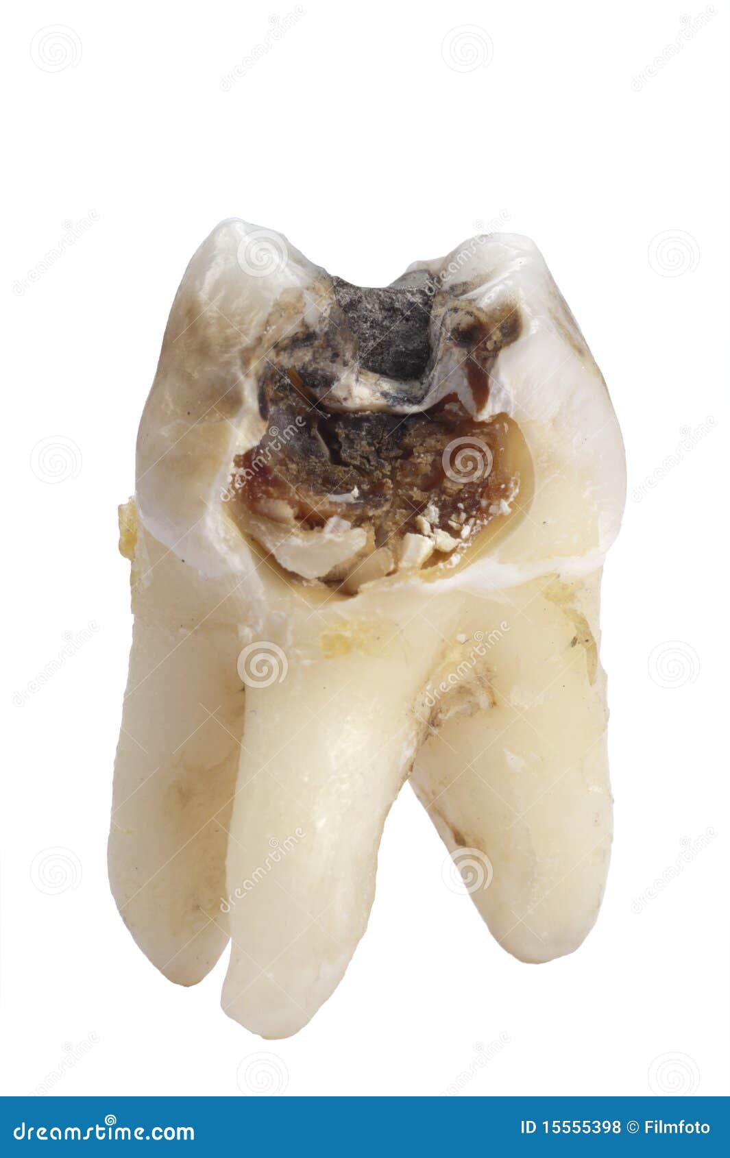 Carie dentale del dente fotografia stock. Immagine di odontoiatria ...