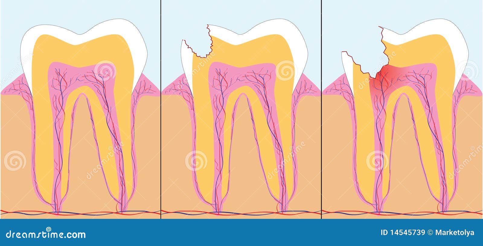 Caries stock vector. Illustration of hygiene, dental - 14545739