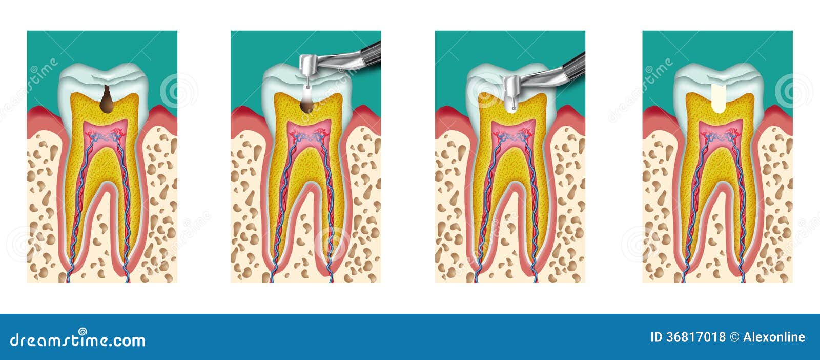Caries Cartoon Vector | CartoonDealer.com #3810385