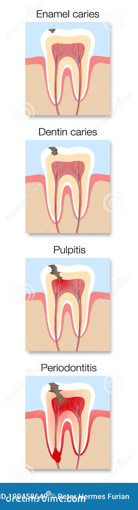 Caries Stages Cartoon Vector | CartoonDealer.com #19737411