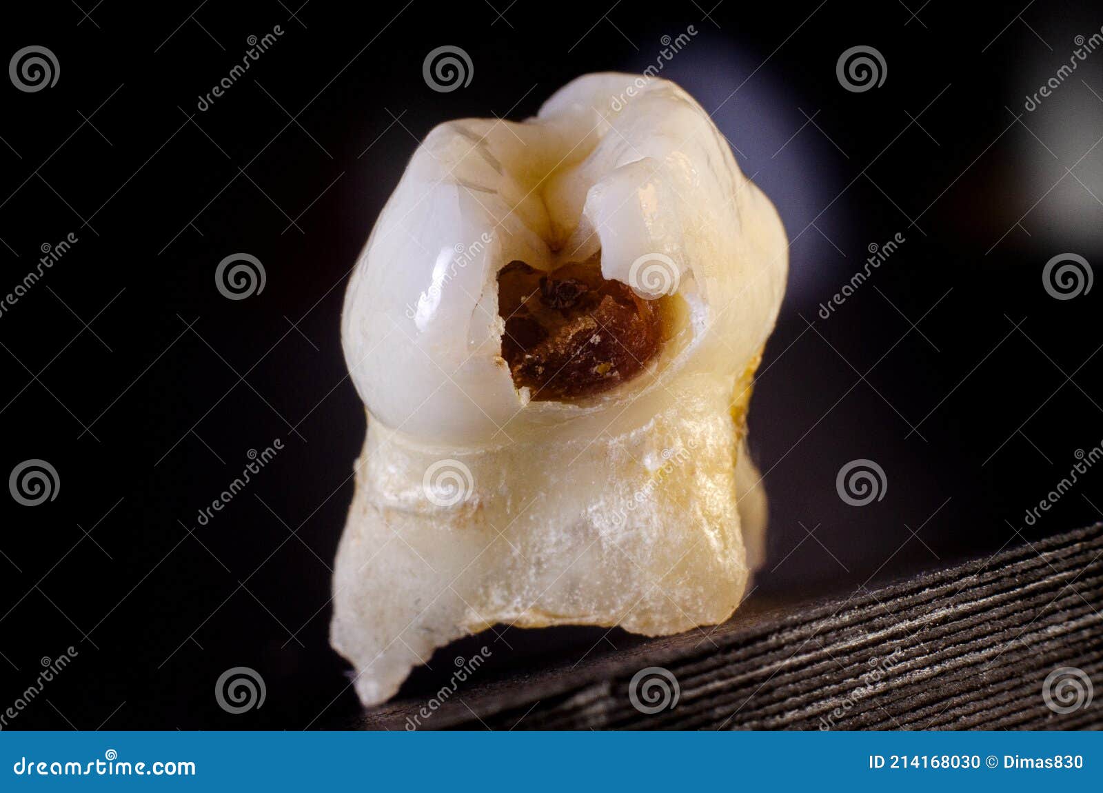 Caries on a Human Tooth on a Dark Background Stock Photo - Image of ...