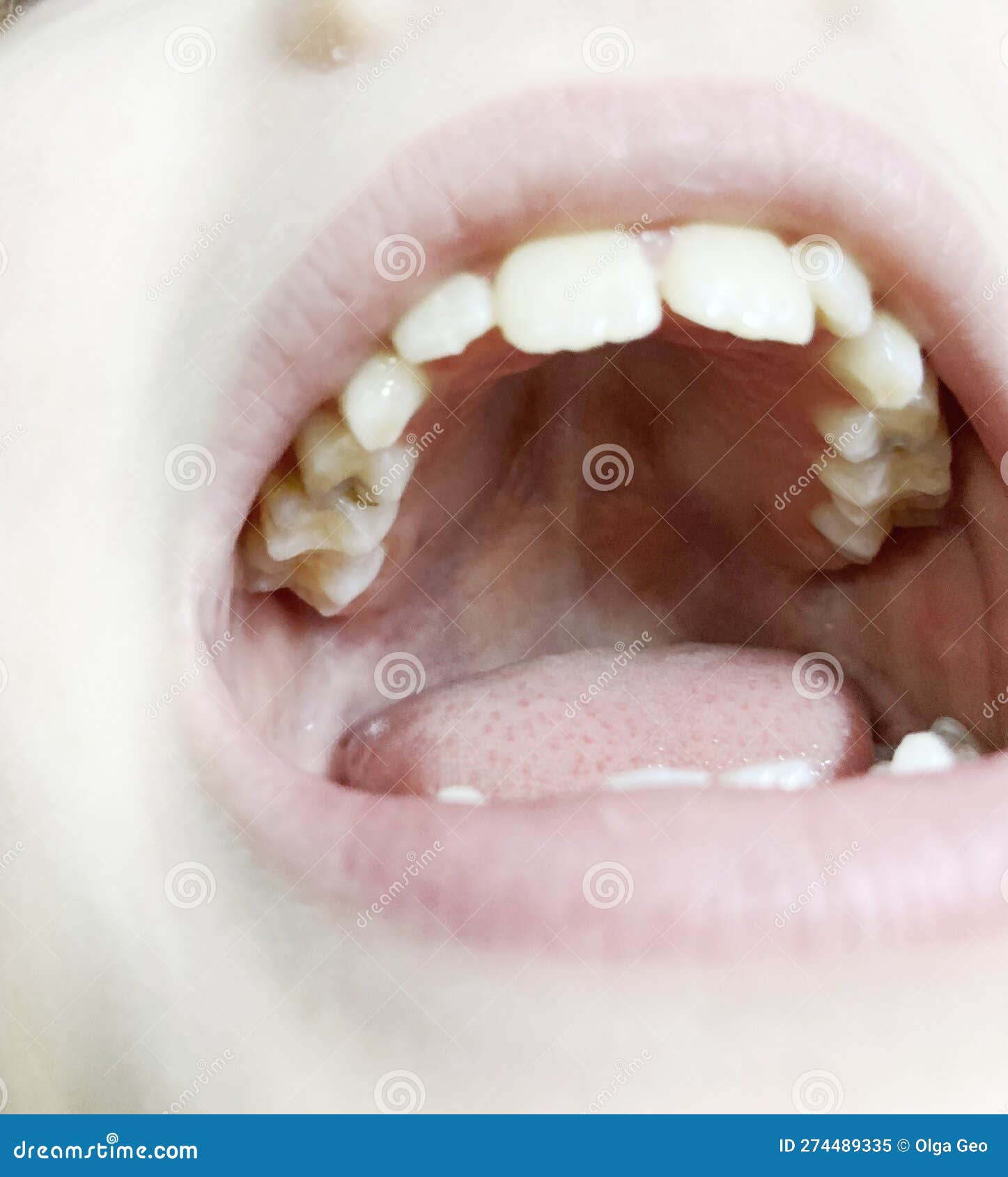 Caries on Milk Upper Chewing Teeth Stock Image - Image of space ...