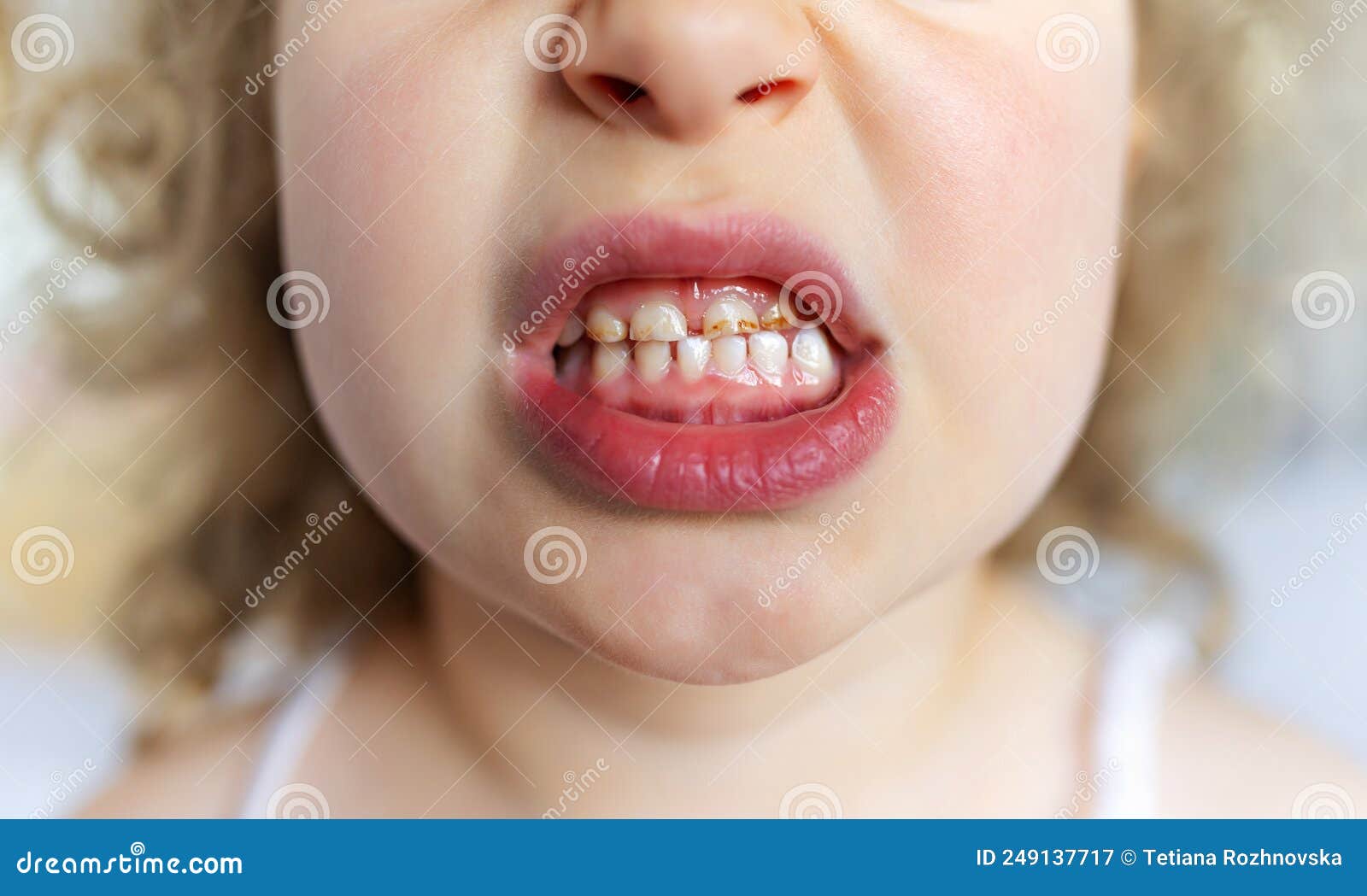 Rotten Teeth Children