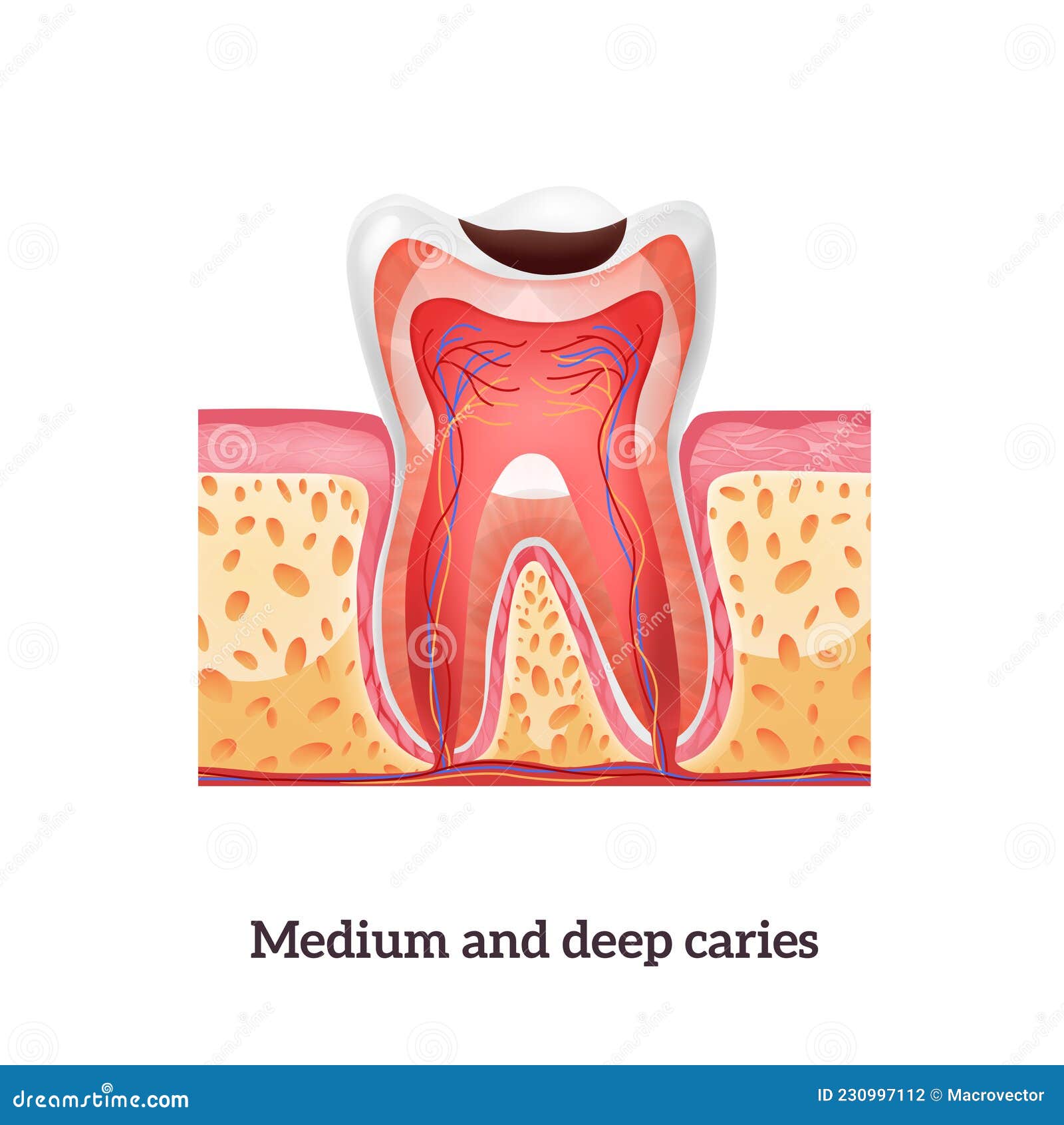 Caries Realistic Illustration Stock Vector - Illustration of cavities ...