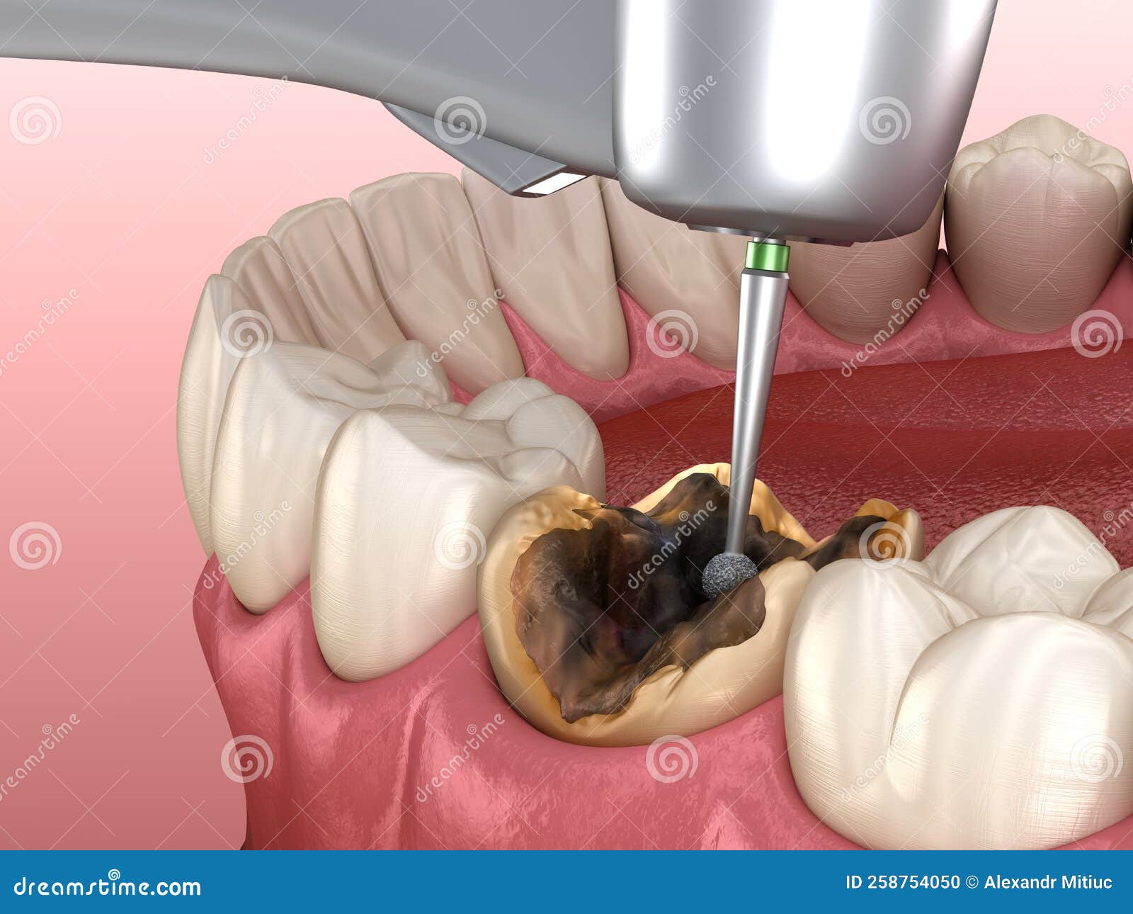 Caries Removing Process. Medically Accurate Tooth Illustration Royalty ...