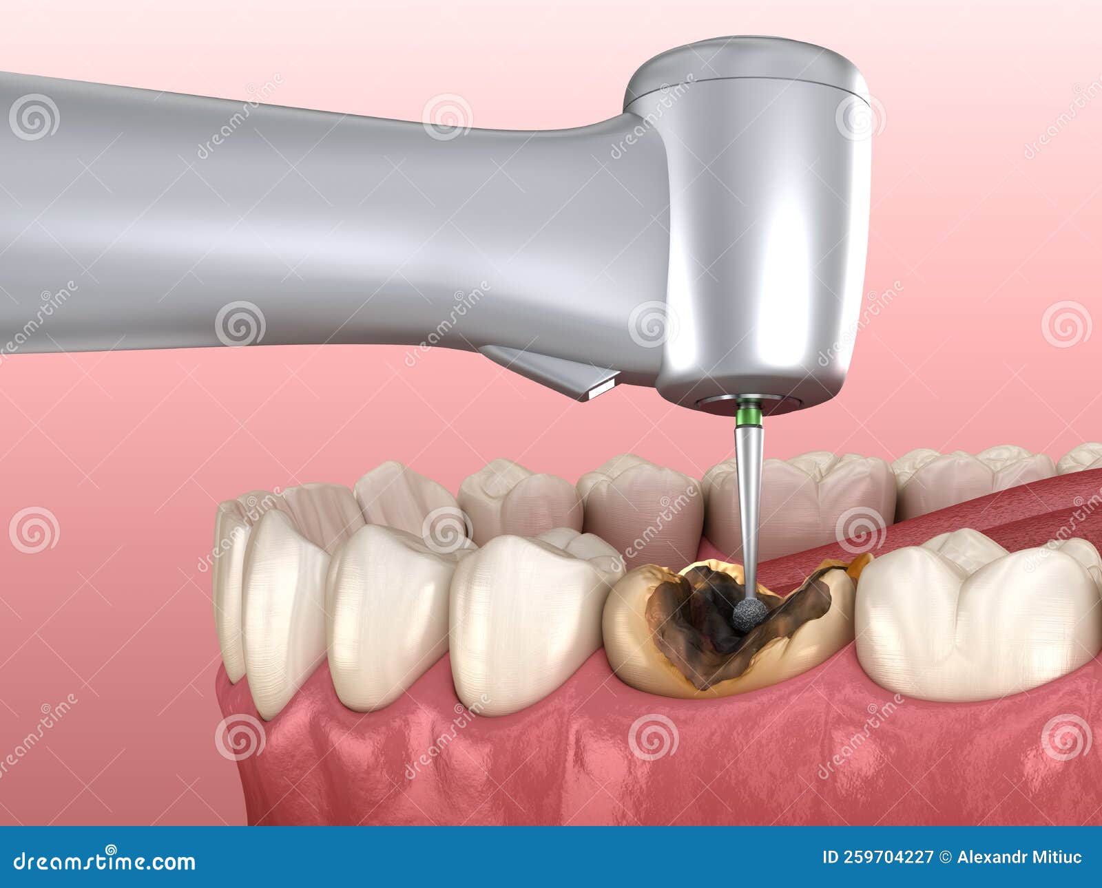 Caries Removing Process. Medically Accurate Tooth Illustration Royalty ...