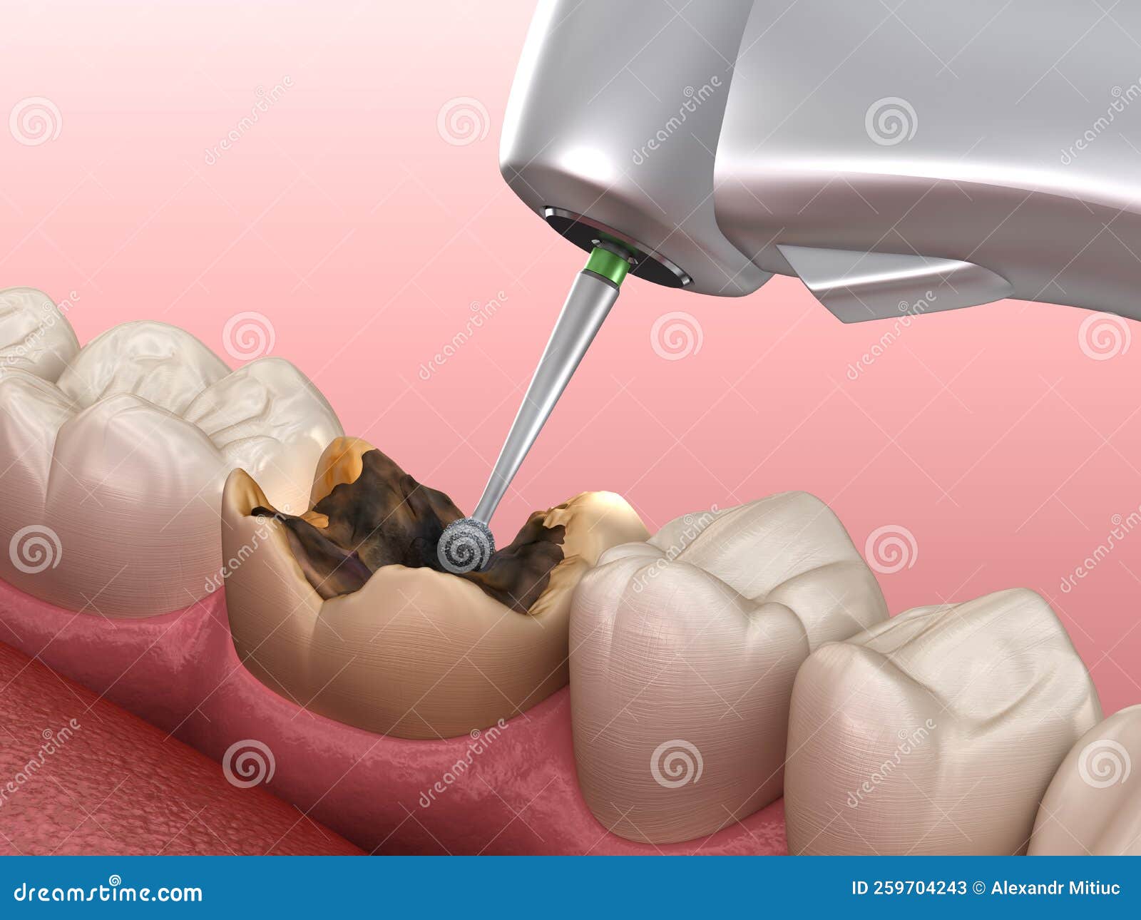 Caries Removing Process. Medically Accurate Tooth Illustration Royalty ... Caries Removing Process. Medically Accurate Tooth Illustration Royalty ...