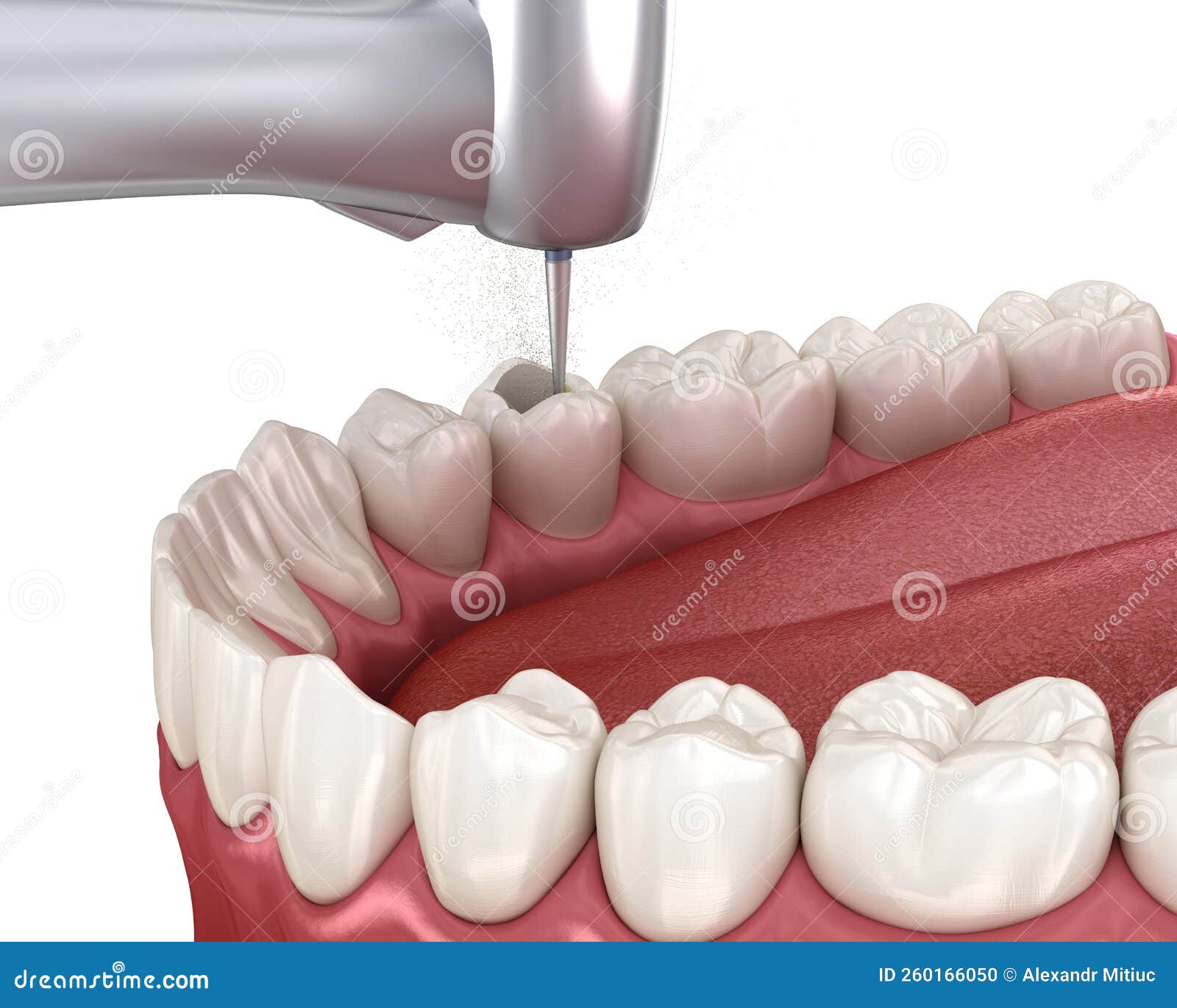 Caries Removing Process. Medically Accurate Tooth Illustration Royalty ... Caries Removing Process. Medically Accurate Tooth Illustration Royalty ...