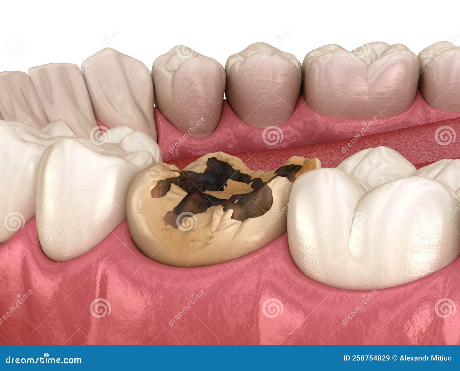 Caries Removing Process. Medically Accurate Tooth 3D Illustration Stock ... Caries Removing Process. Medically Accurate Tooth 3D Illustration Stock ...