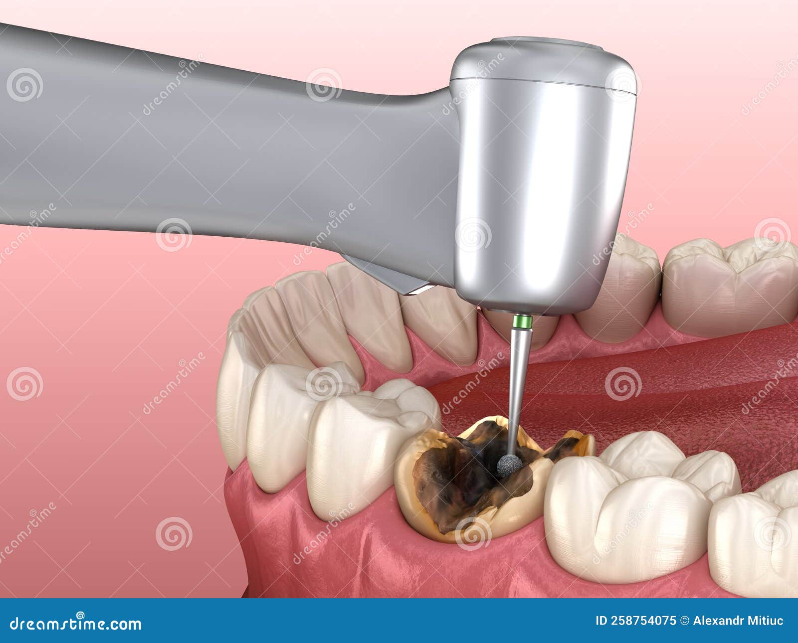 Caries Removing Process. Medically Accurate Tooth 3D Illustration Stock ... Caries Removing Process. Medically Accurate Tooth 3D Illustration Stock ...