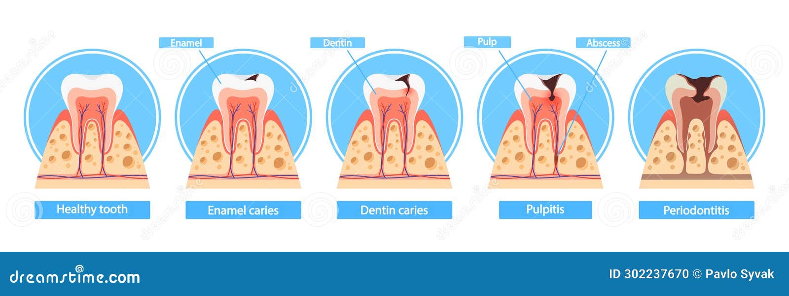 Caries Stages Infographics Healthy Tooth Enamel Caries Dentin Caries Pulpitis And