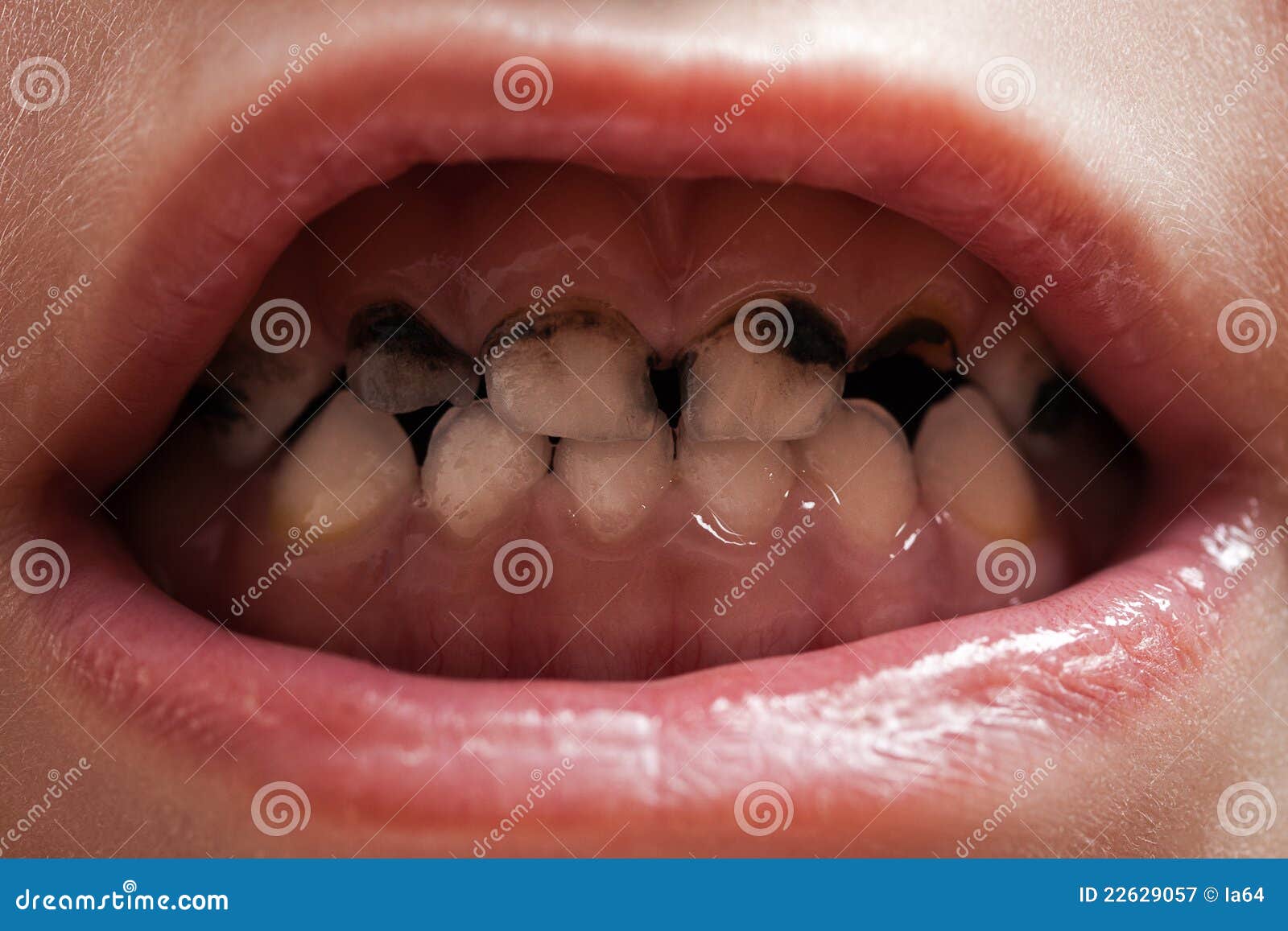 Caries Teeth Decay Royalty Free Stock Photography - Image: 22629057