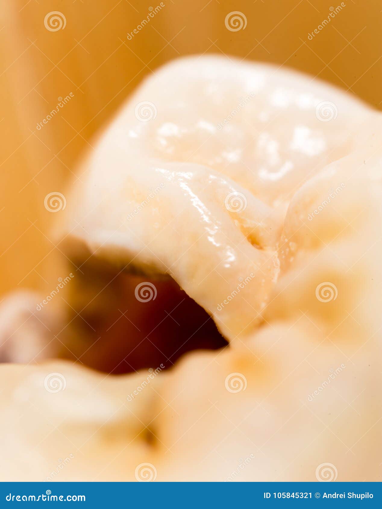 Caries on the Teeth of a Man Stock Image - Image of human, disease ...