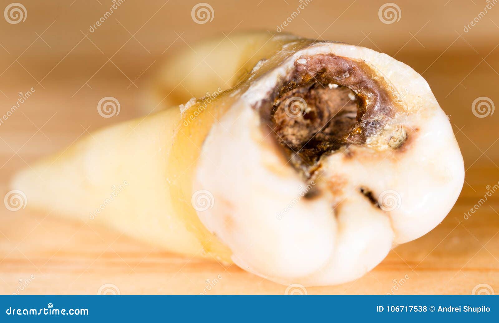 Caries on the Teeth of a Man Stock Photo - Image of stomatology, dental ...