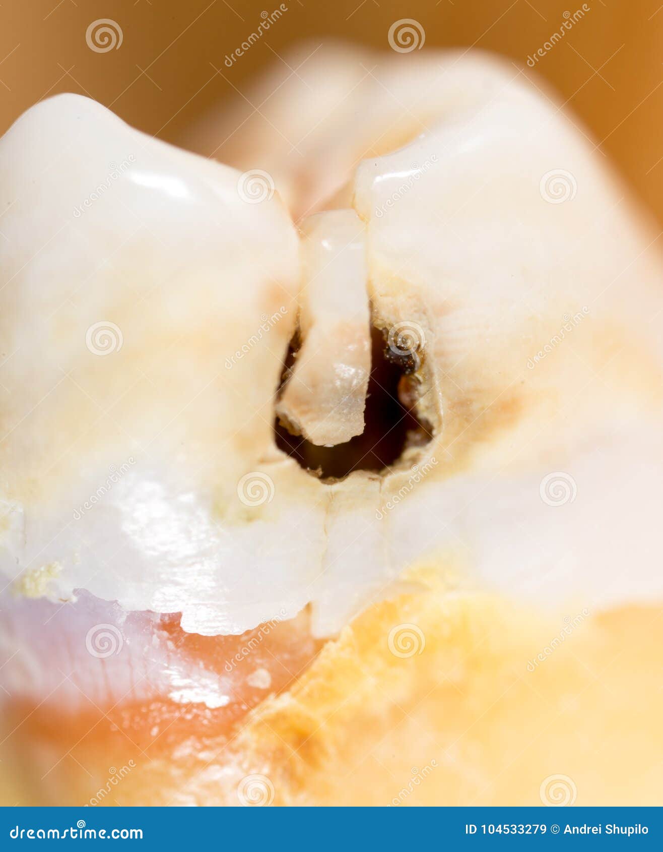 Caries on the Teeth of a Man Stock Image - Image of black, disease ...