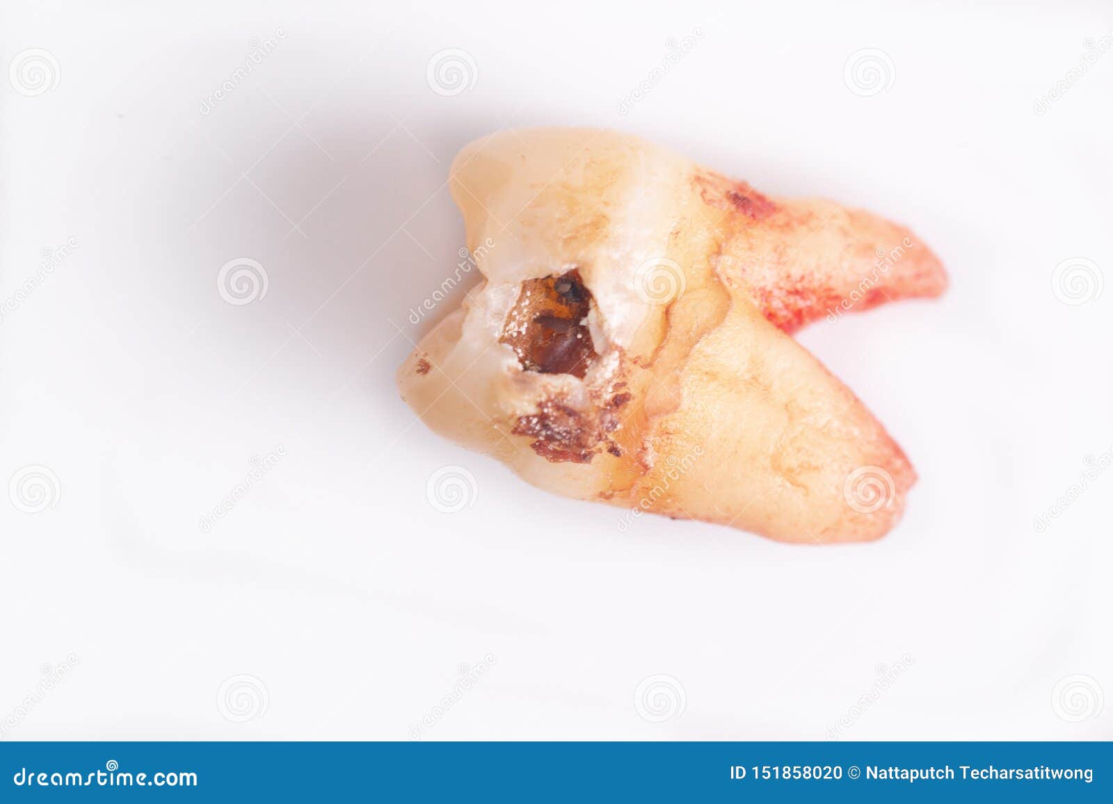 Caries on the Teeth on the White Background Stock Photo - Image of ...