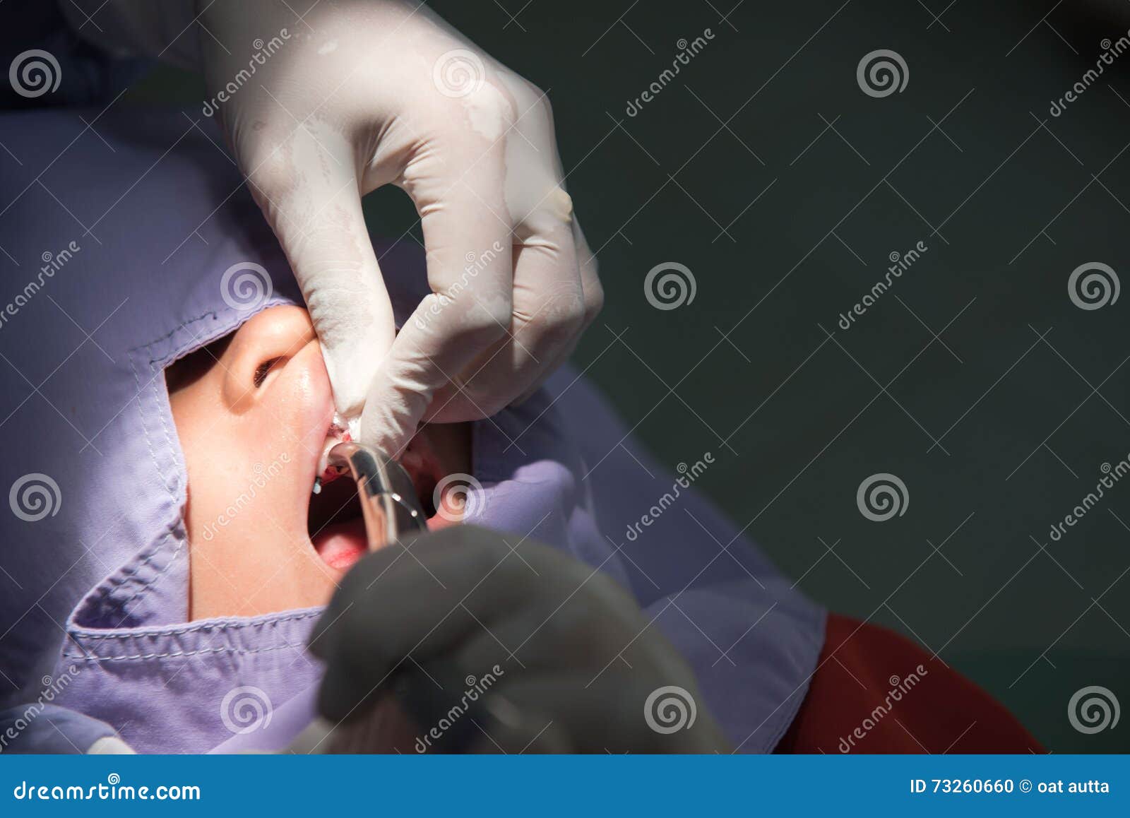 Caries Tooth Extraction by the Dentist. Dentistry in Hospital Stock ...