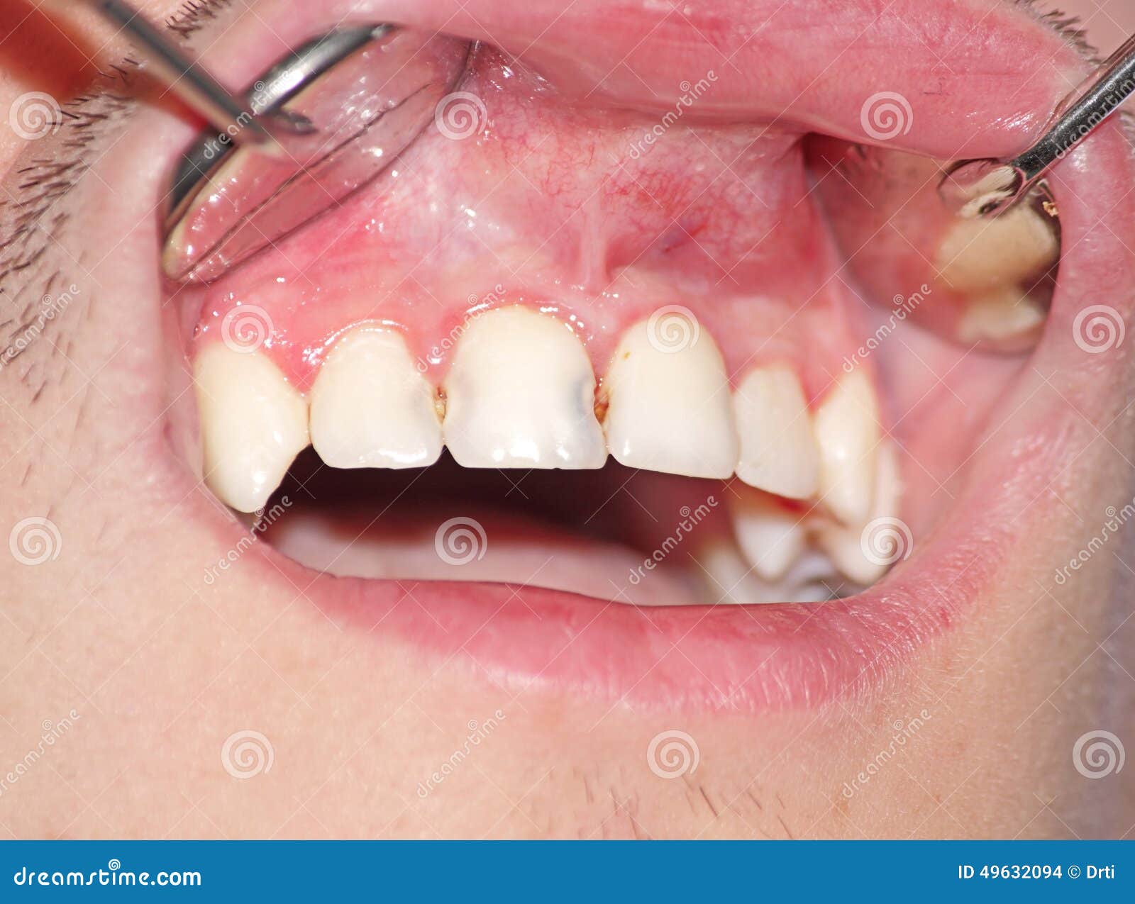 Caries of the Upper Incisors Stock Photo - Image of cavity, sickness ...