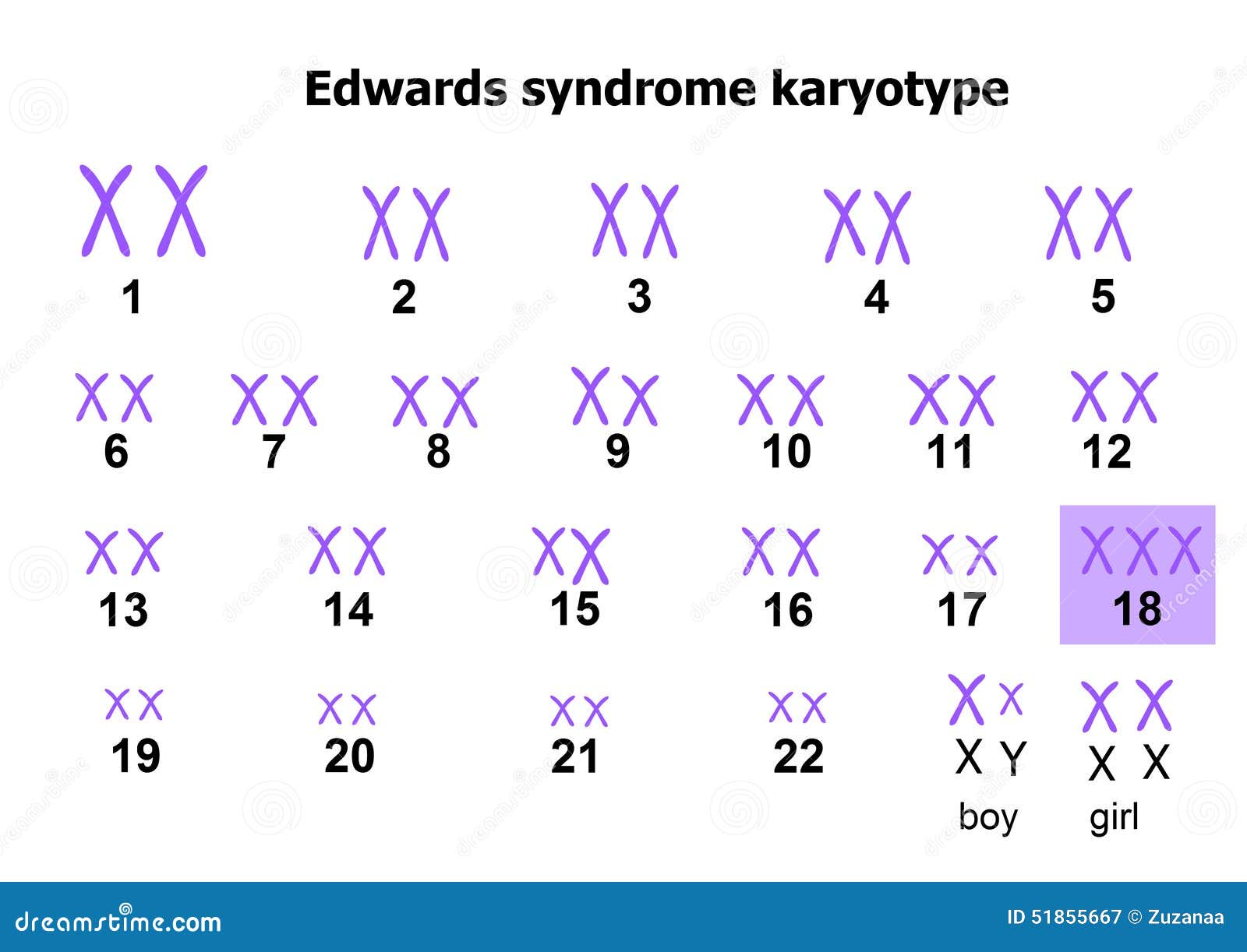Sindrome Di Edwards Cariotipo Screening E Diagnosi Anomalie Genetiche