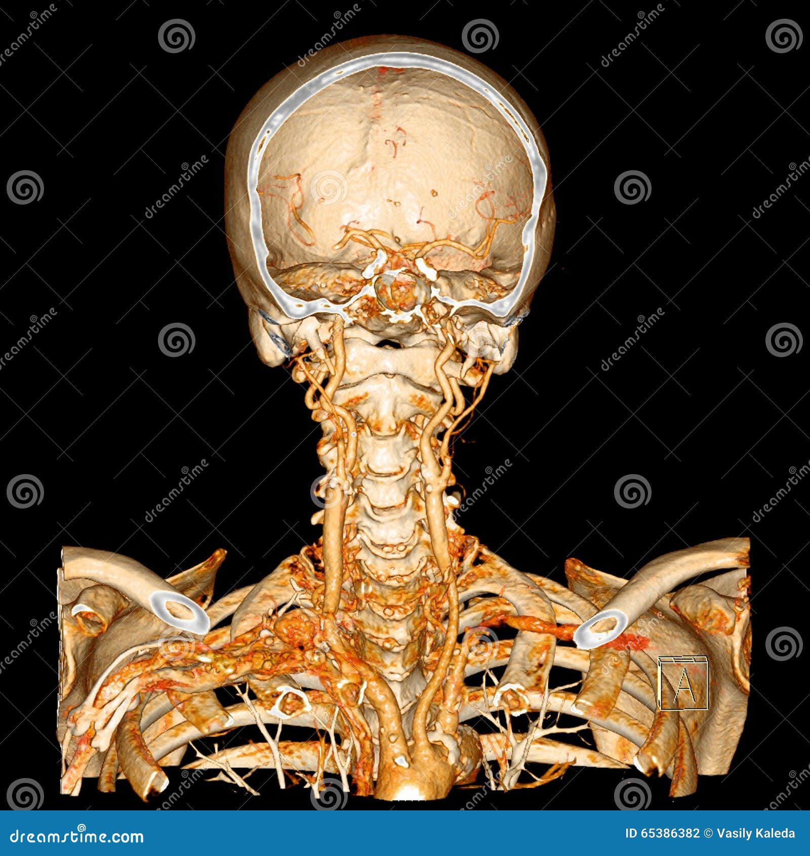 Mri Carotid Artery Complete Occlusion Stock Image | CartoonDealer.com ...