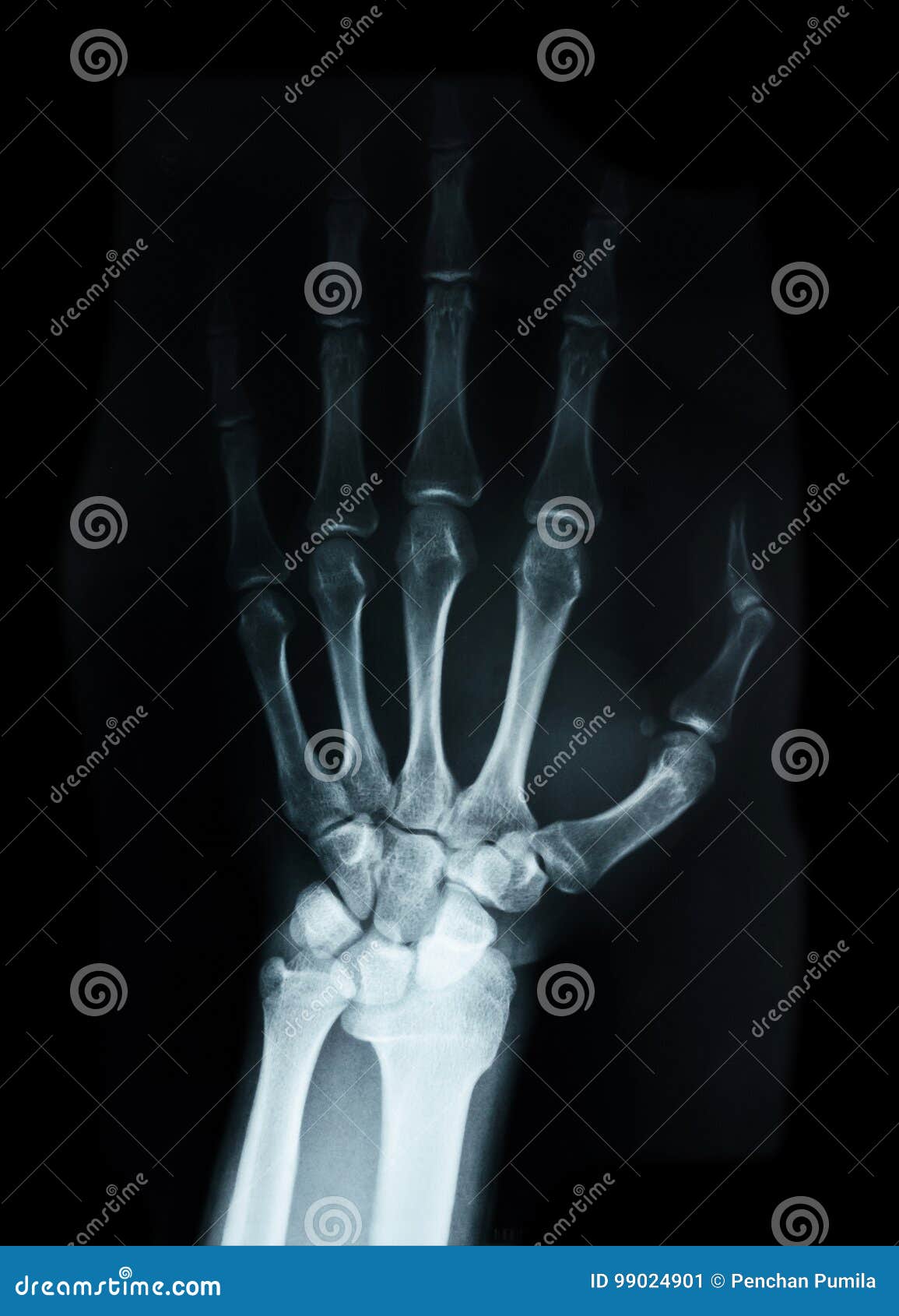Carpal bones Human X Ray. stock image. Image of hand - 99024901