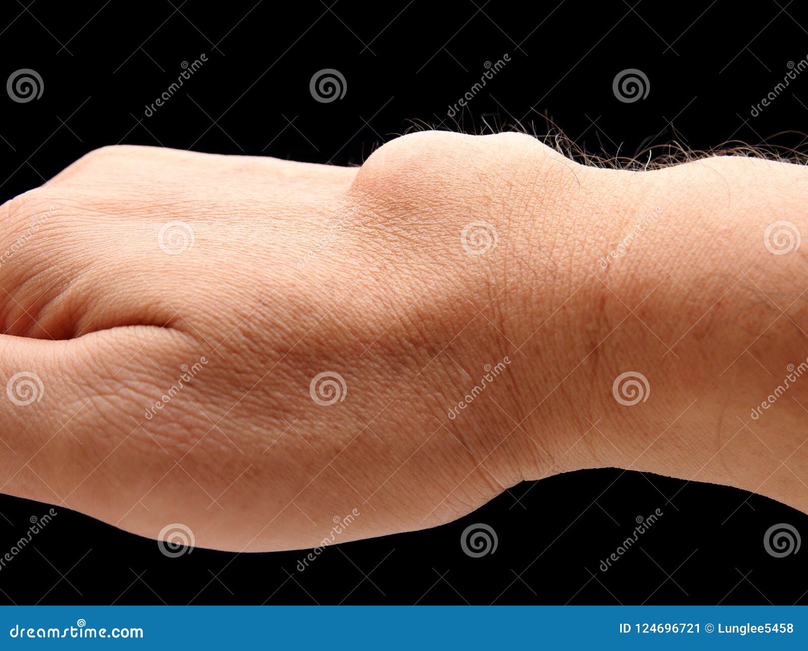Ganglion Cyst On Palm