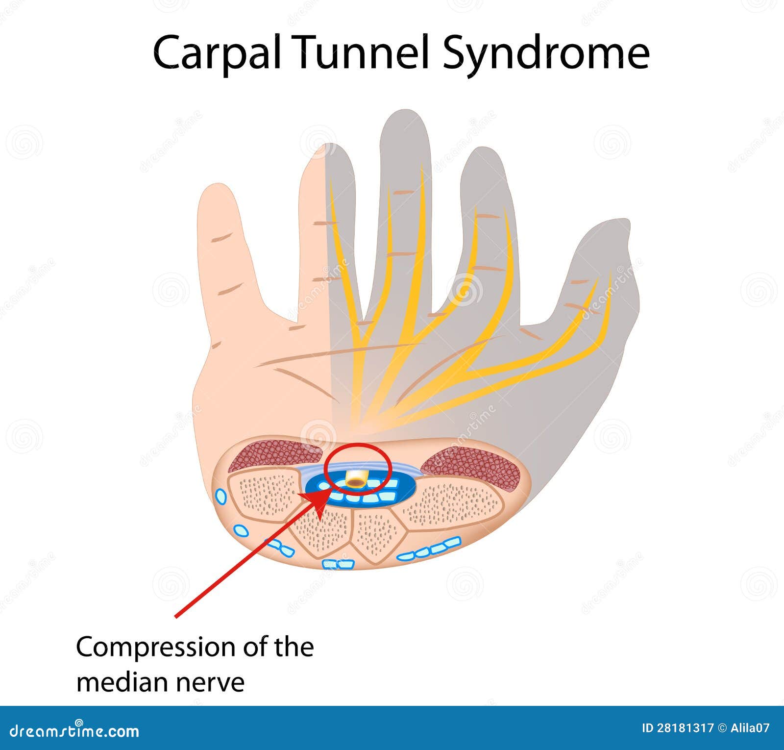 Carpal tunnel syndrome stock vector. Illustration of healthcare - 28181317