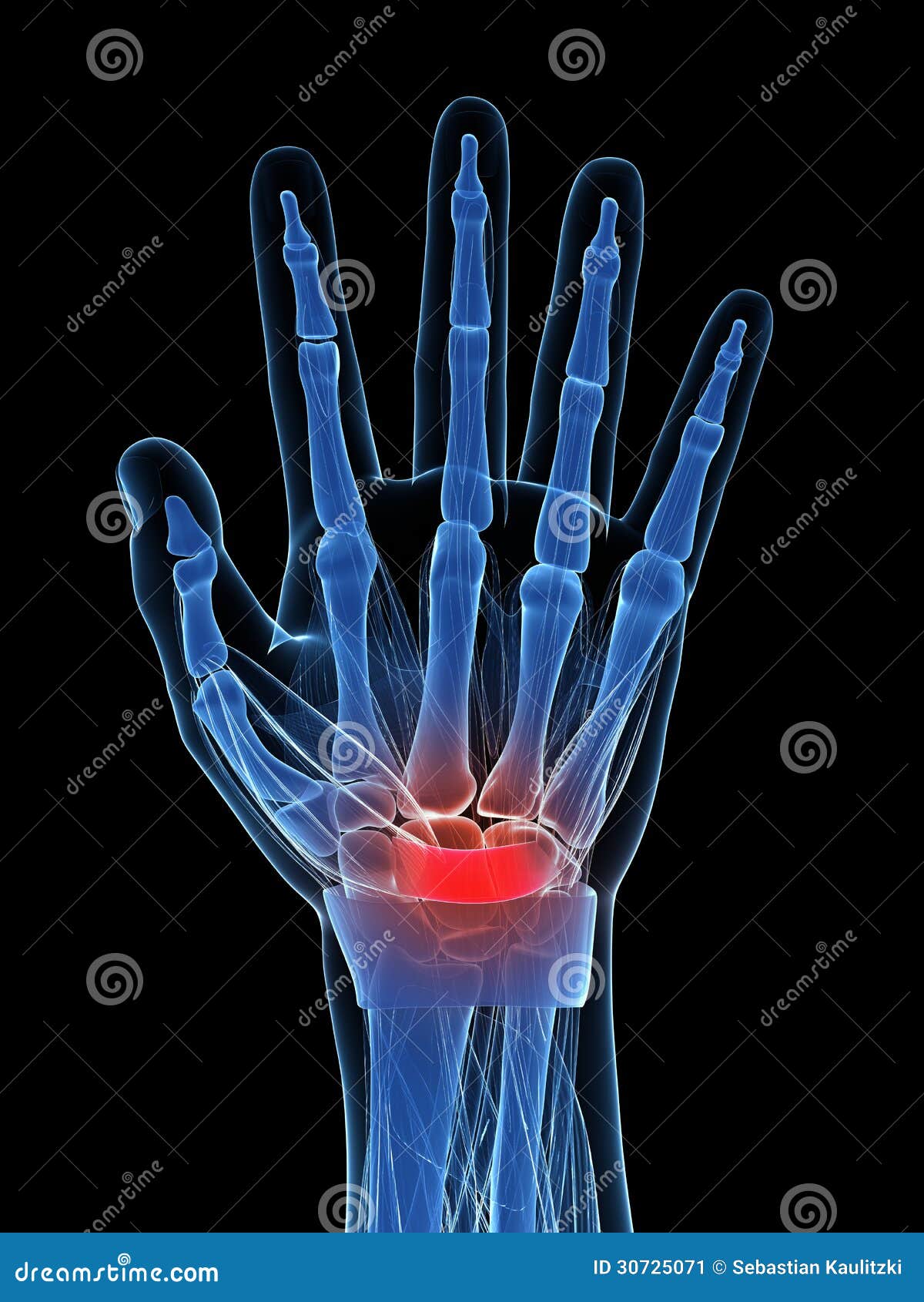 Carpal Tunnel Syndrome Cartoon Vector | CartoonDealer.com #9314645