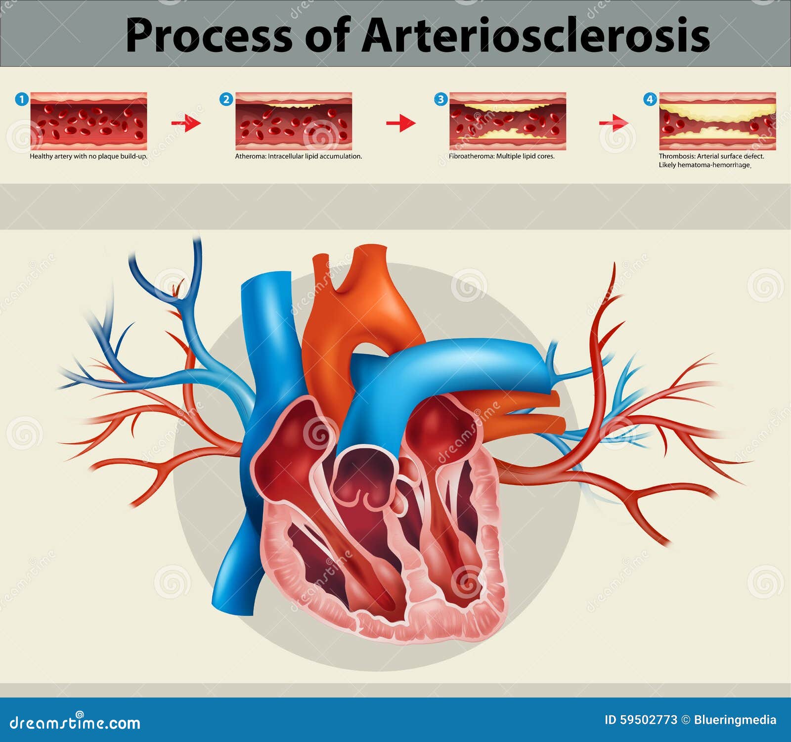 Cartaz Do Processo De Arteriosclerose Ilustração Stock - Ilustração de ...