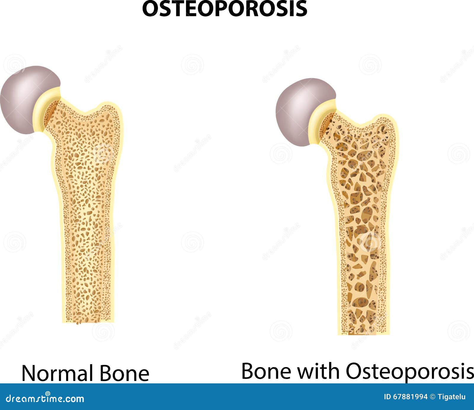 3D Illustration Of Hip Bone Diagram Hip Bone Anatomy Stock Image ...