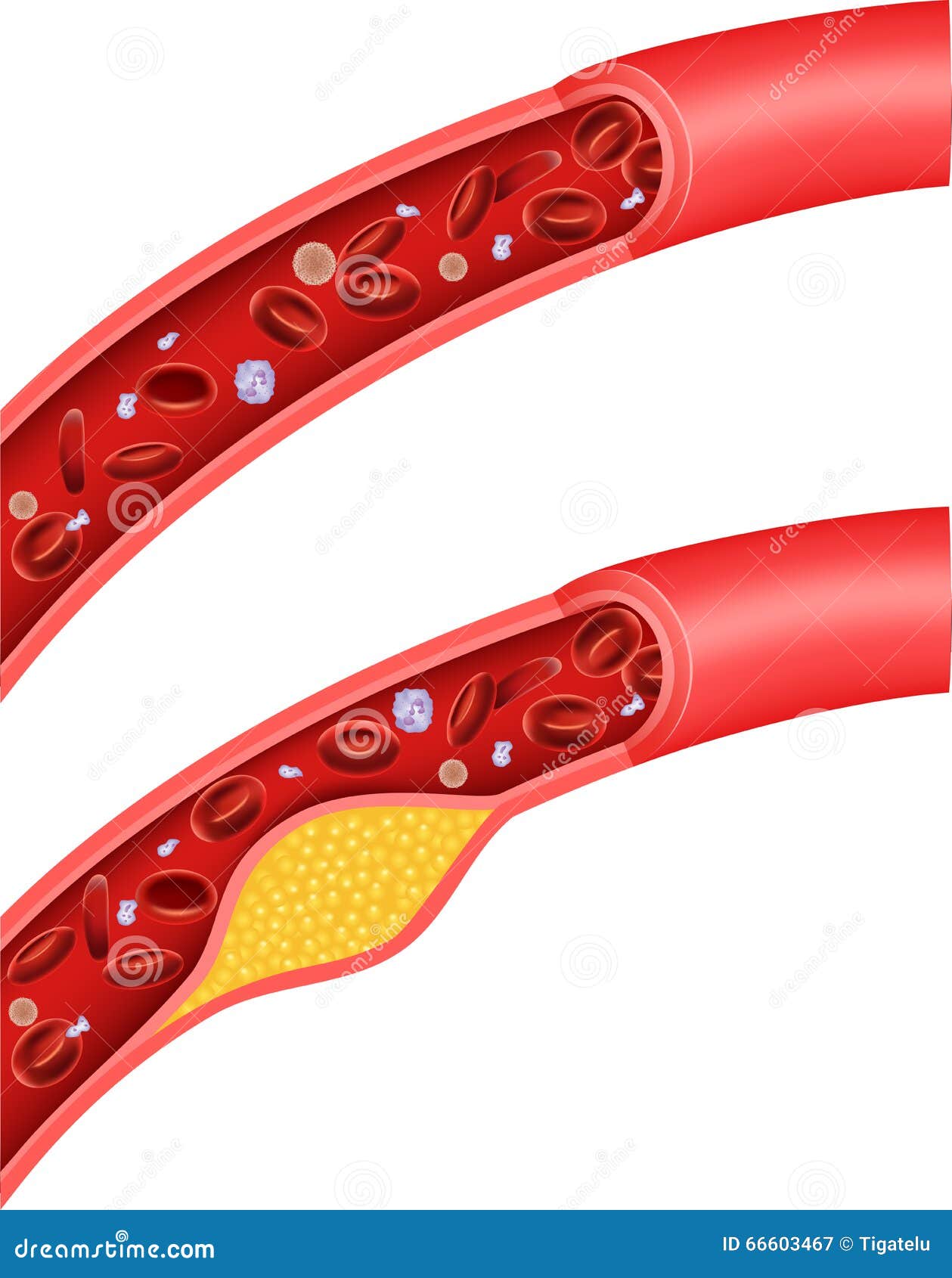 Cartoon Illustration Of Cholesterol Blocking Artery | CartoonDealer.com ...
