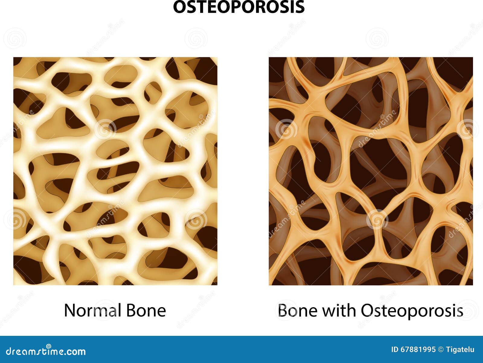 Normal Bone Structure Density And With Osteoporosis Royalty-Free Stock ...
