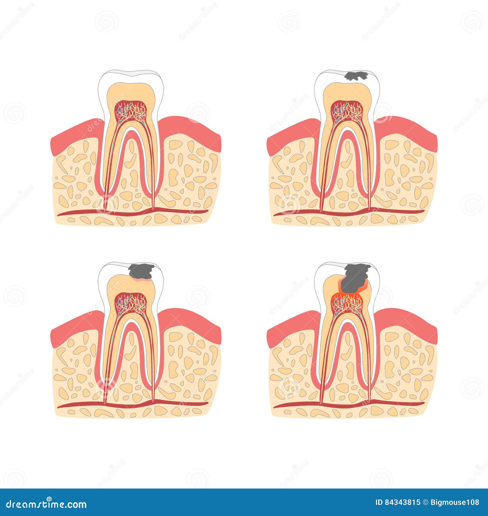 Cartoon Tooth With Stages Of Dental Caries Formation Set Vector Stock