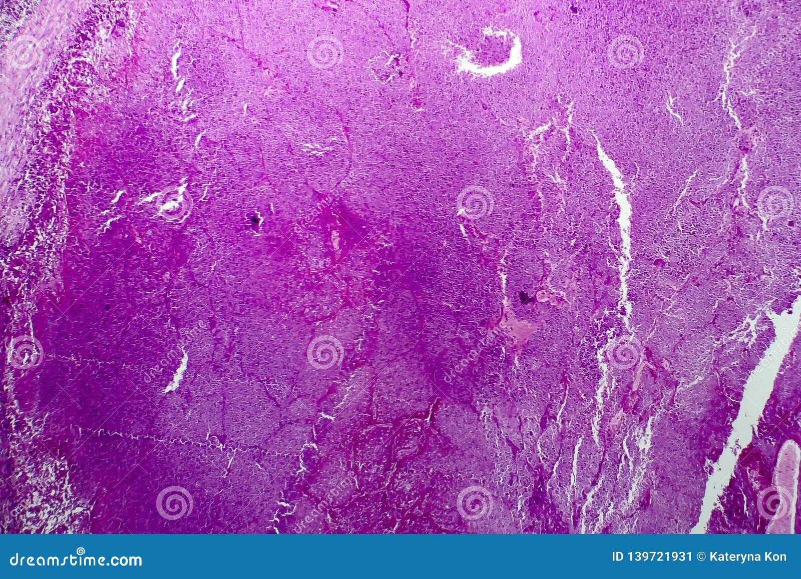 Caseous Necrosis In Tb Caseous Necrosis In Tb