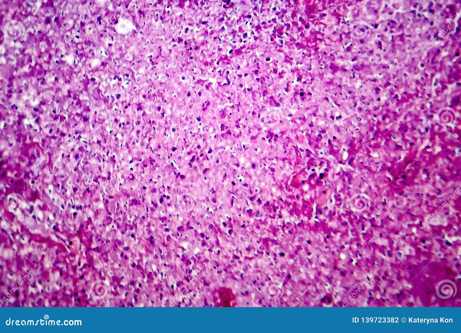 Caseation Of Human Tuberculosis Granuloma, Light Micrograph Stock ...