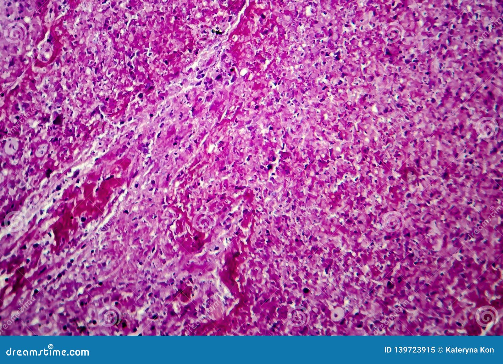 Caseous Necrosis In Tb Caseous Necrosis In Tb