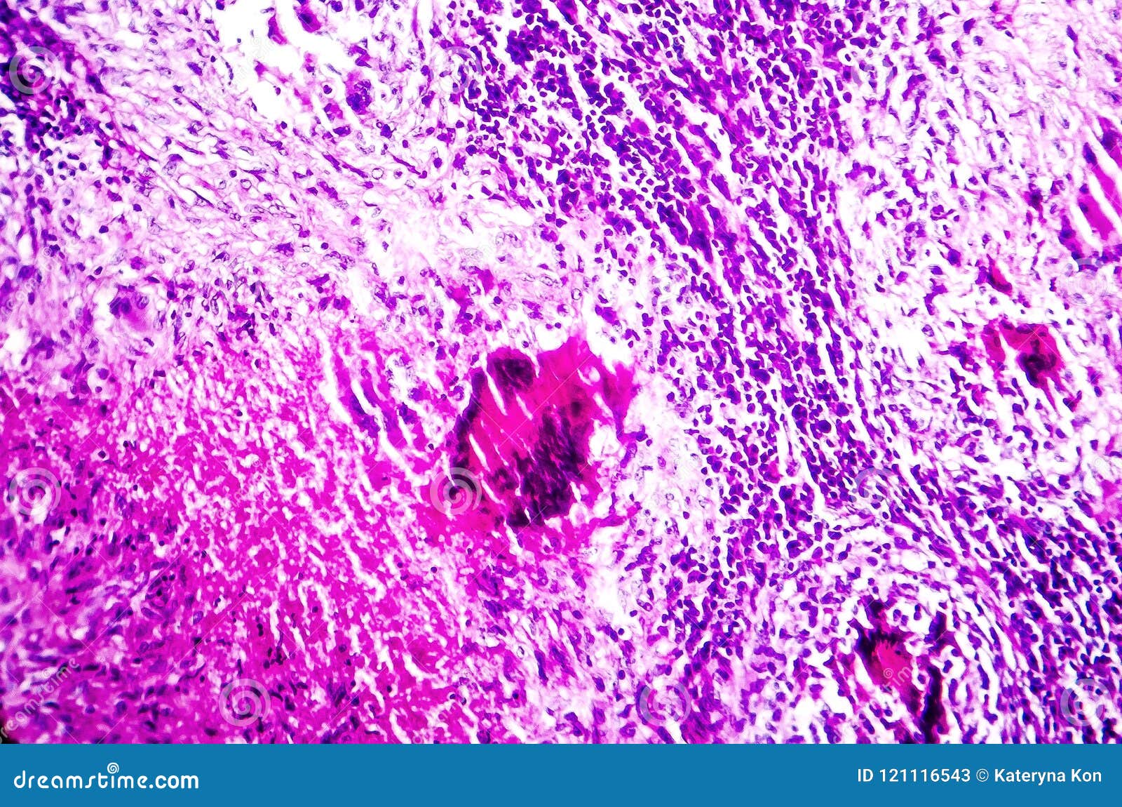 Caseous Necrosis Lymph Node