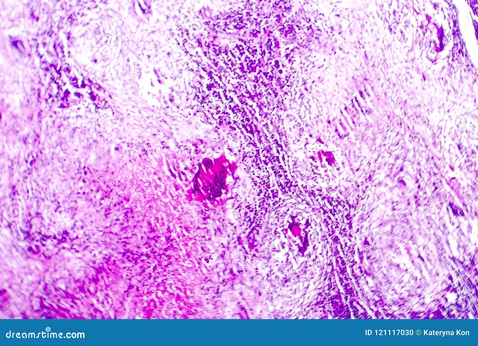 Caseous Necrosis of Lymphatic Node Stock Photo - Image of lymphatic ...