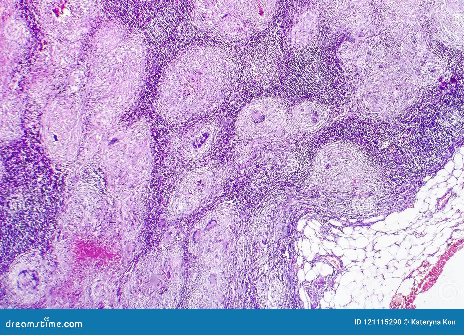 Caseous Necrosis Of Lymphatic Node Royalty-Free Stock Image ...