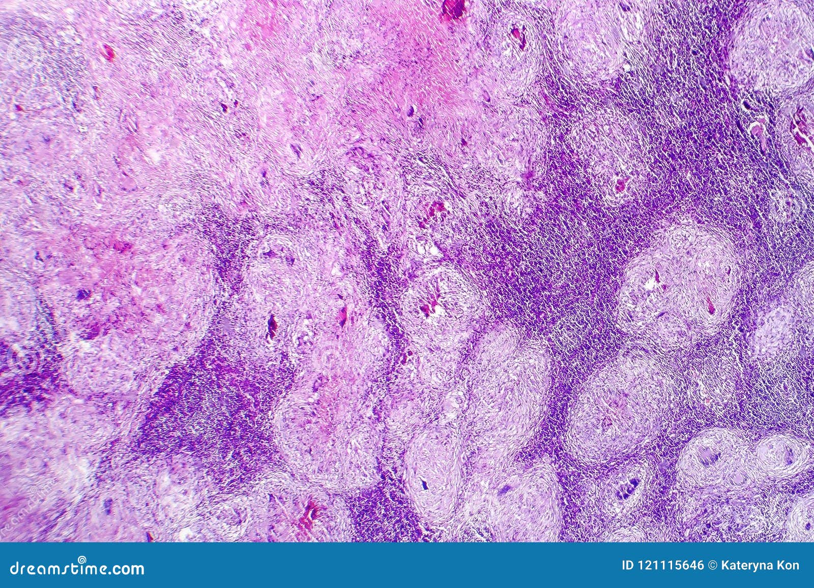 Caseous Necrosis In Tb