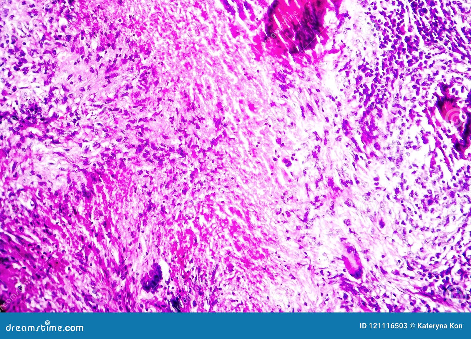 Caseous Necrosis Histology