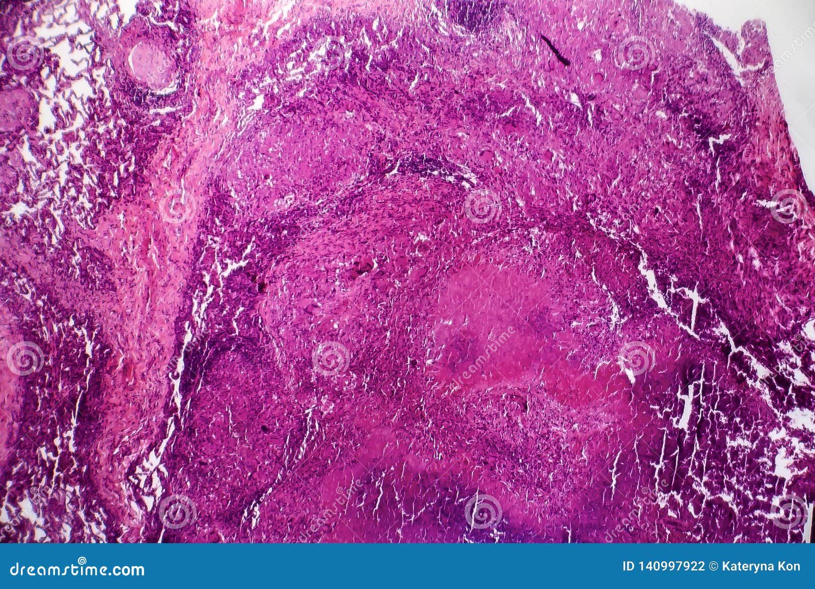 Caseous Pneumonia, Light Micrograph Stock Photo - Image of infection ...