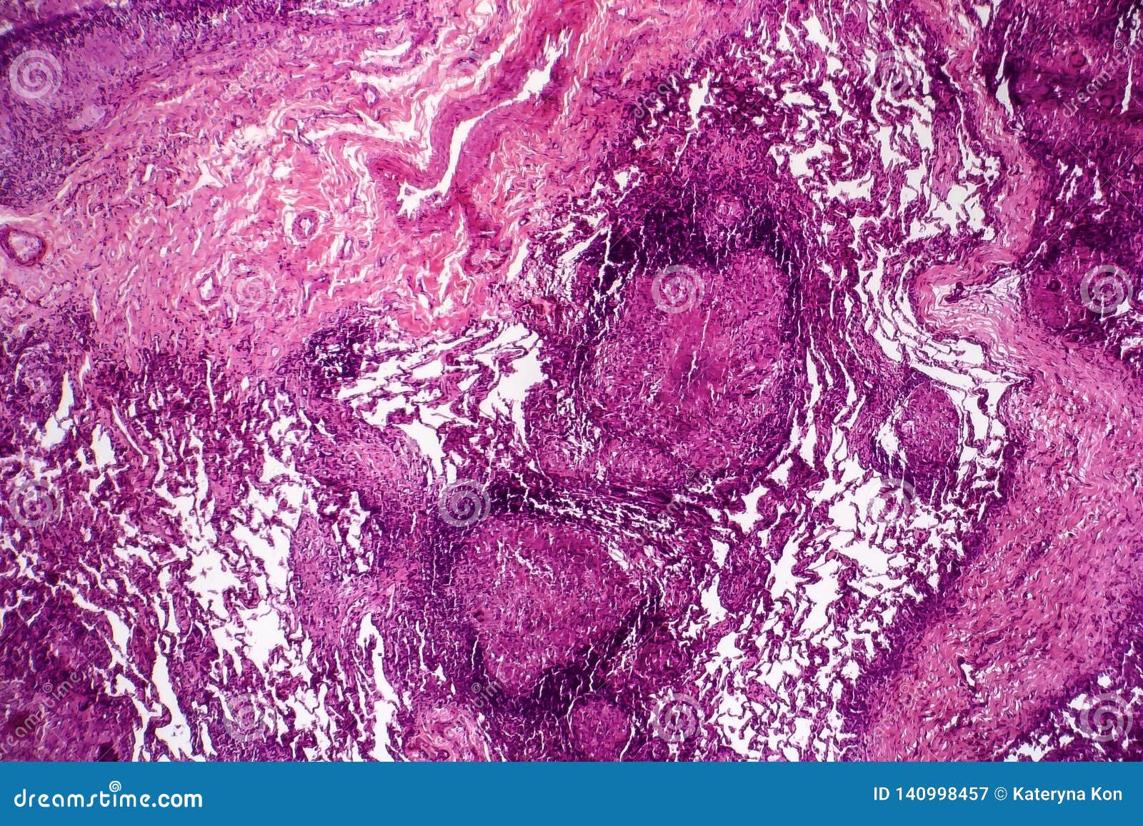 Caseous Pneumonia, Light Micrograph Stock Image - Image of medical ...