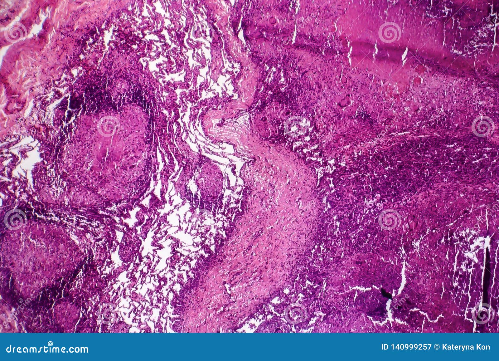 Caseous Pneumonia, Light Micrograph Stock Image - Image of inflammation ...