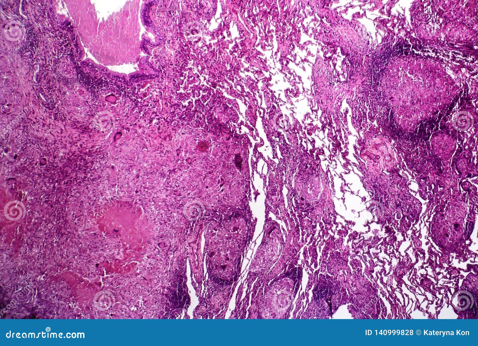 Caseous Pneumonia, Light Micrograph Stock Photo - Image of morphology ...