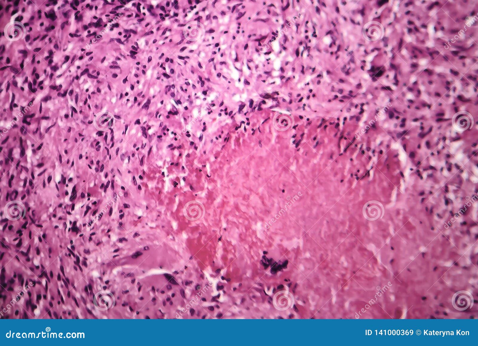 Caseous Pneumonia, Light Micrograph Stock Image - Image of ...